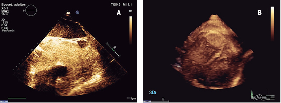 Intramyocardial dissecting hematoma of the right ventricle secondary to ...