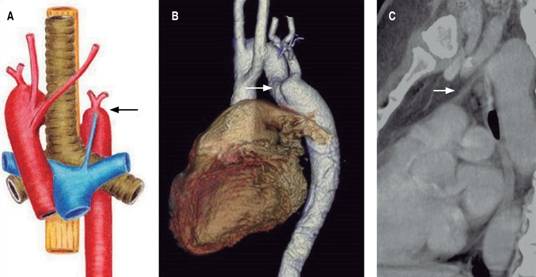 Locating ductal ligaments in vascular rings using multidetector ...