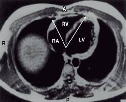 Electrocardiographic analysis of V1-V4 leads in infarction by proximal ...