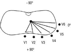 Electrocardiographic analysis of V1-V4 leads in infarction by proximal ...