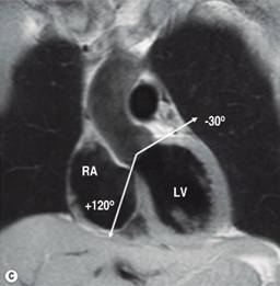 Electrocardiographic analysis of V1-V4 leads in infarction by proximal ...