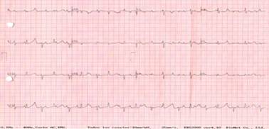 Permanent pacemaker implantation in complete congenital fetal ...