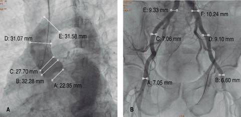 TAVI in Intermediate-risk patients: a review in purpose of a case