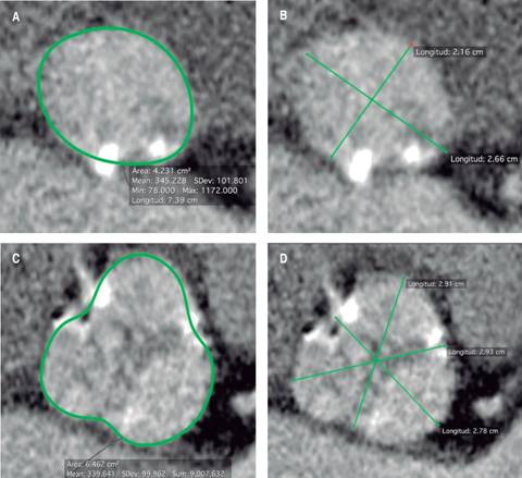 TAVI in Intermediate-risk patients: a review in purpose of a case