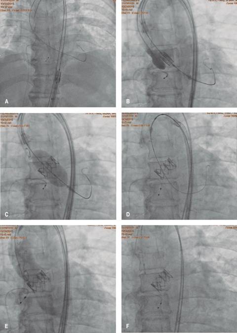 TAVI in Intermediate-risk patients: a review in purpose of a case