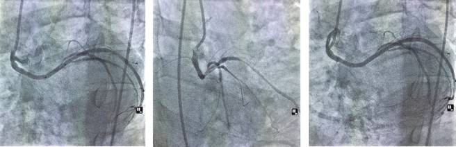 Acute coronary syndrome associated with anomalous origin of circumflex ...