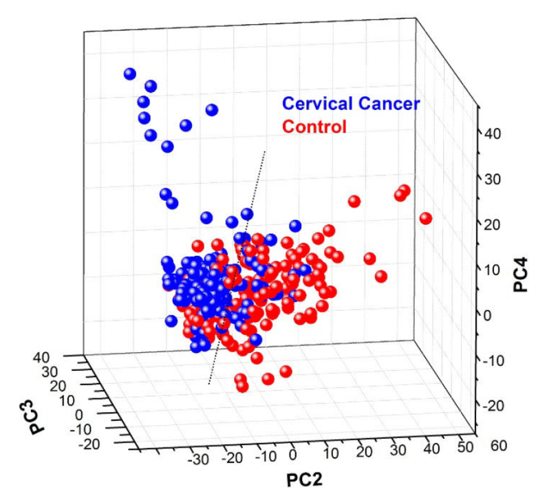 Cervical cancer detection based on serum sample surface enhanced Raman ...