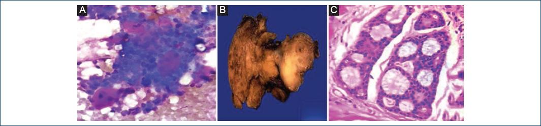 Cytohistological correlation in salivary gland, in the Hospital General ...