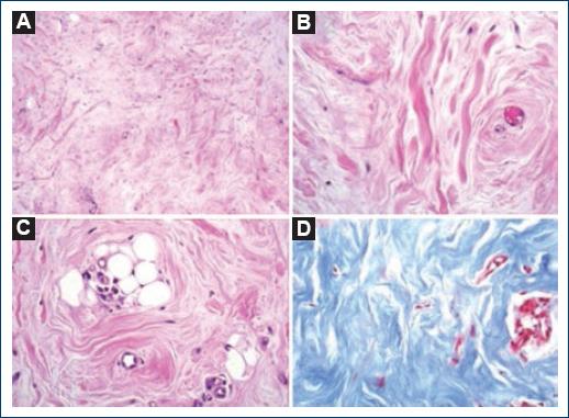 Diabetic mastopathy: report of two cases and literature review