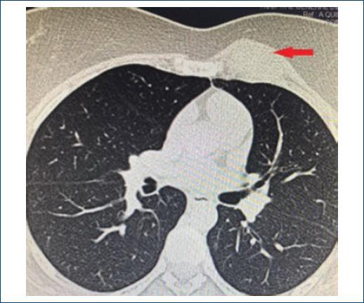 Chest wall soft-tissue tuberculosis: A case report