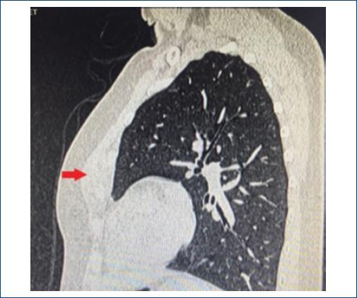 Chest wall soft-tissue tuberculosis: A case report