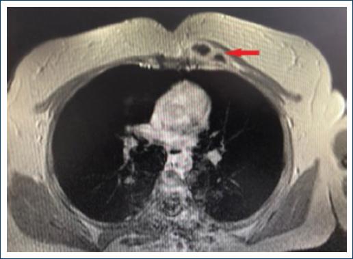 Chest wall soft-tissue tuberculosis: A case report