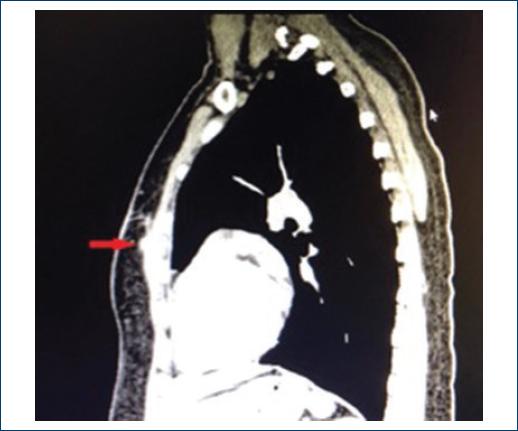 Chest wall soft-tissue tuberculosis: A case report