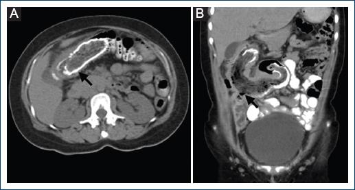 Transmural colonic migration of a retained surgical sponge (Gossypiboma ...