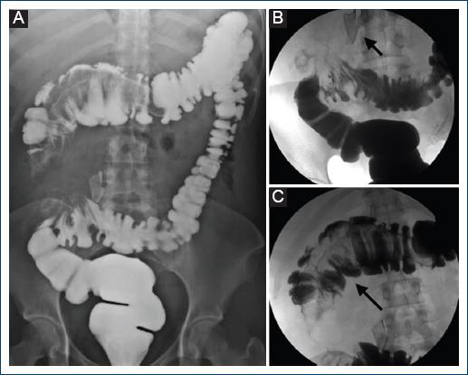 Transmural colonic migration of a retained surgical sponge (Gossypiboma ...