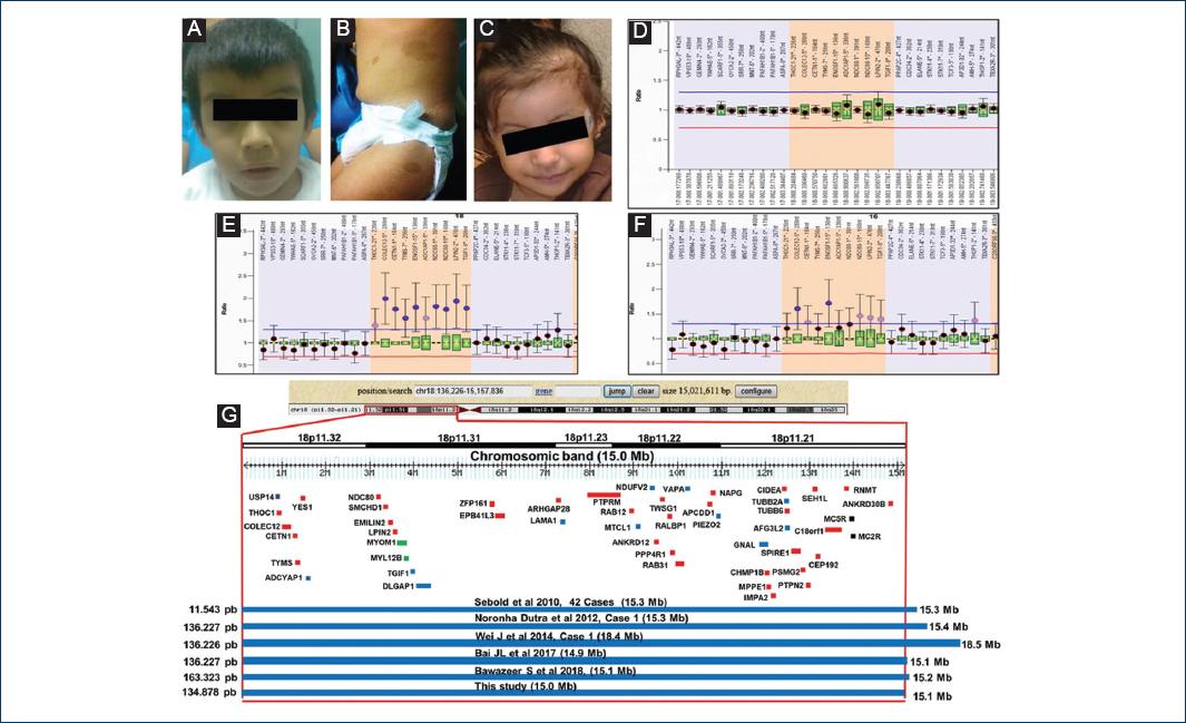 Characterization of two children with tetrasomy 18p syndrome through ...