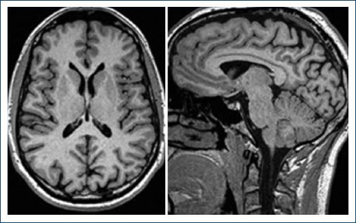 Miller Fisher variant Guillain-Barre syndrome: A case review
