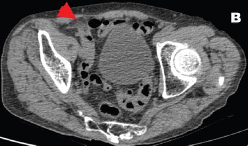 Surgical mesh migration with Rutkow-Robbins technique causing ...