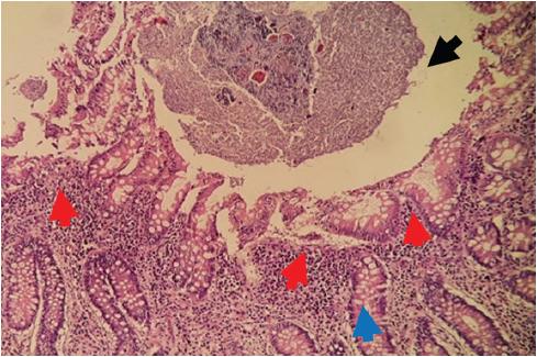 Surgical mesh migration with Rutkow-Robbins technique causing ...