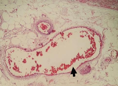 Surgical mesh migration with Rutkow-Robbins technique causing ...
