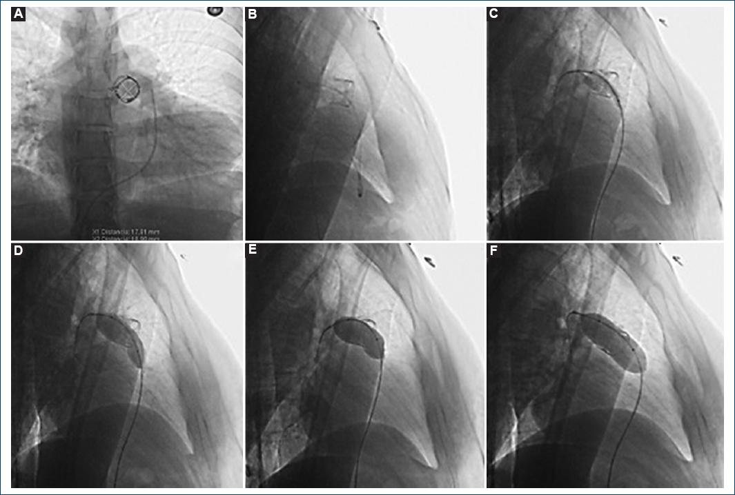 Percutaneous balloon valvuloplasty in a pregnant patient with pulmonary ...