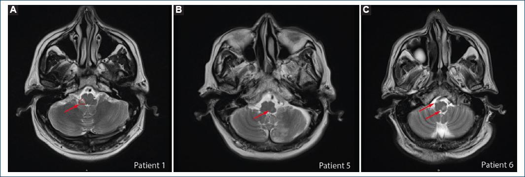 Oropharyngeal dysphagia spectrum in Wallenberg syndrome: a case report