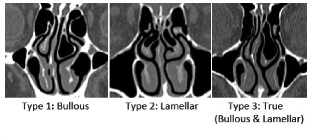 Concha bullosa and nasal septum by tomographic study; experience at the ...