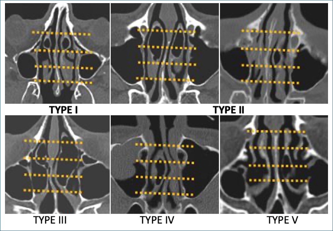 Concha bullosa and nasal septum by tomographic study; experience at the ...