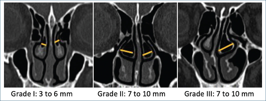 Concha bullosa and nasal septum by tomographic study; experience at the ...