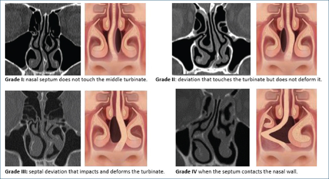 Concha bullosa and nasal septum by tomographic study; experience at the ...