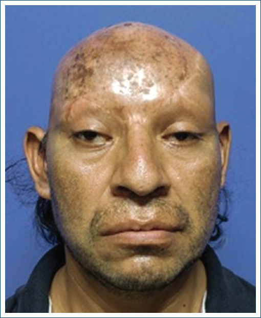 Alternative methods of skull reconstruction for giant sarcomas