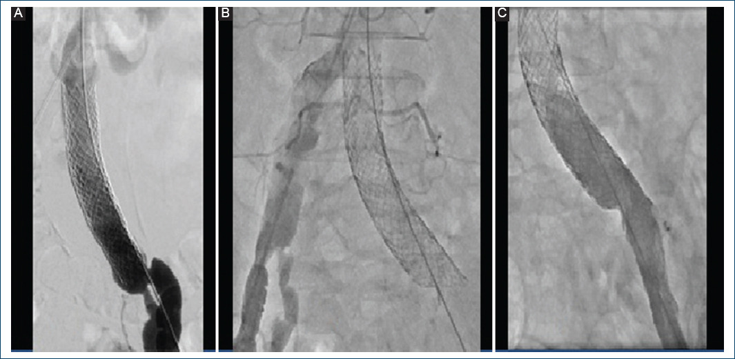 Therapeutic description of common iliac artery aneurysms. Number of cases