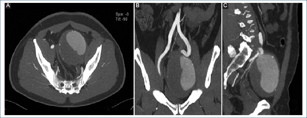 Therapeutic description of common iliac artery aneurysms. Number of cases