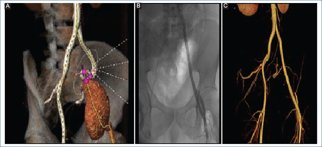 Therapeutic description of common iliac artery aneurysms. Number of cases