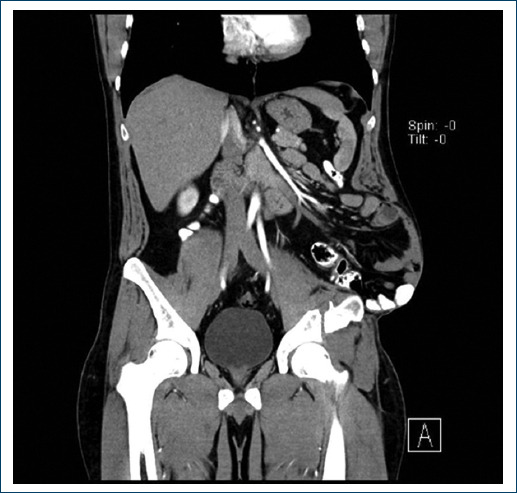 Abdominal reconstruction in a patient with flank hernia after trauma, a ...