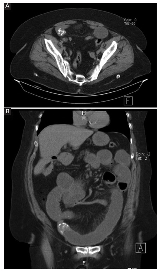 Biliary ileus an uncommon cause of intestinal occlusion: case report