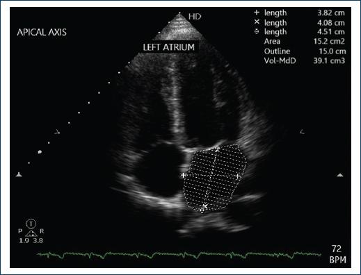 Barlow syndrome: a diagnostic difficulty