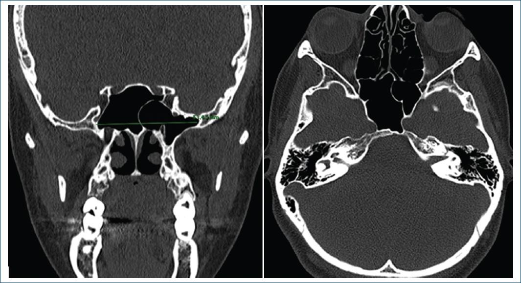 Tomographic classification proposal for safe endoscopic surgery of the ...
