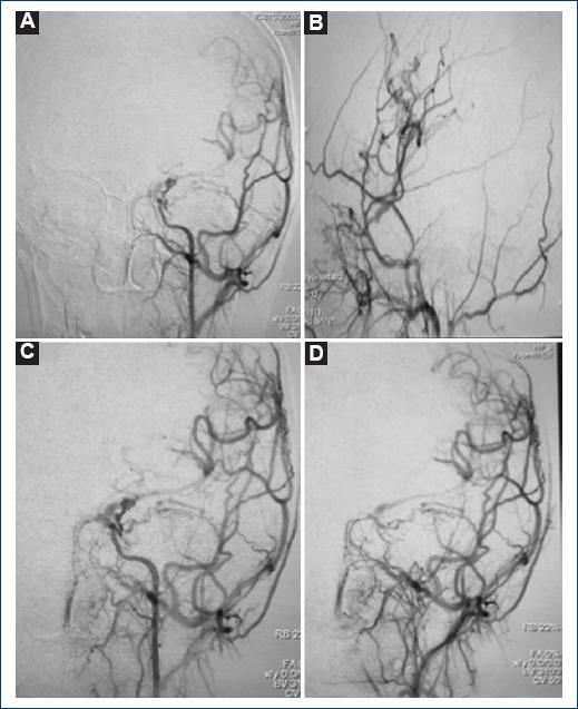 Moyamoya disease: review and demographic description of a series of ...