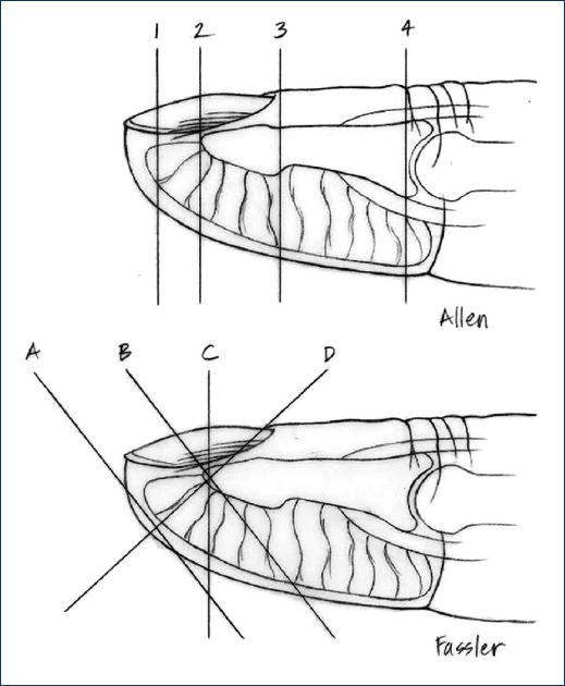 Management of Allen II digital tip injury with cross flap in a ...