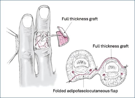 Management of Allen II digital tip injury with cross flap in a ...