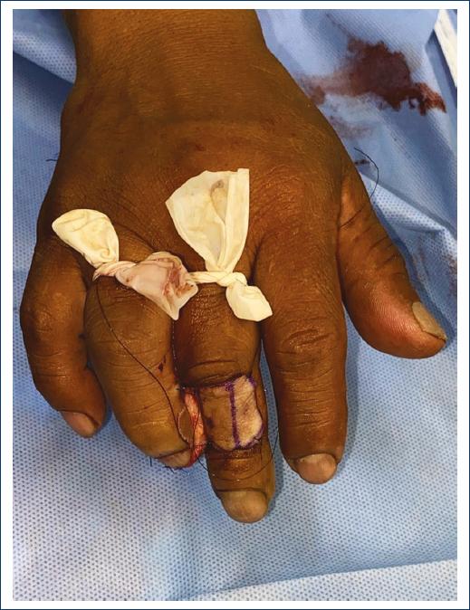 Management of Allen II digital tip injury with cross flap in a ...