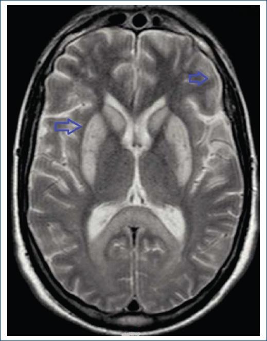 Hypoxic-ischemic brain injury: literature review