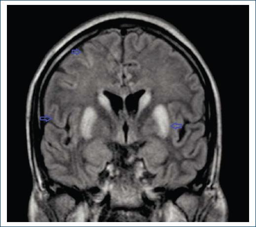 Hypoxic-ischemic brain injury: literature review
