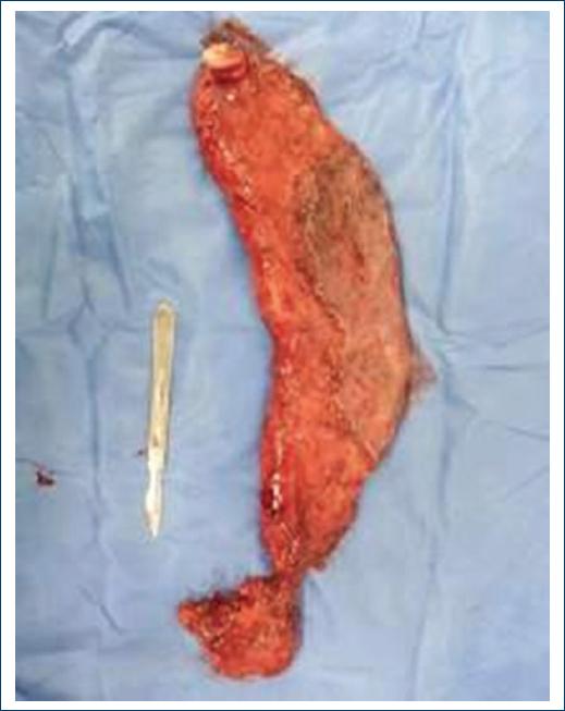 Thoracoscopic esophagectomy with gastric pull-up in megaesophagus ...