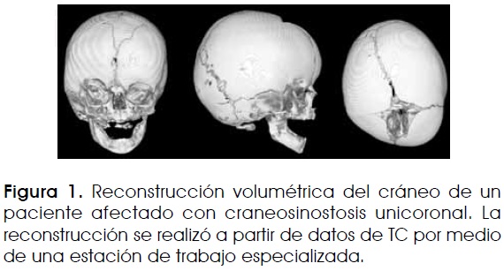 Clasificación de malformaciones craneales causadas por craneosinostosis ...