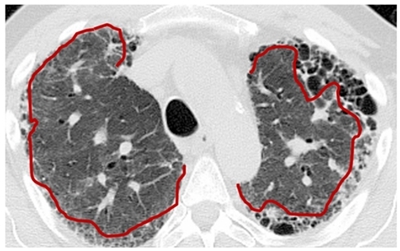 Sistema de Apoyo para la Cuantificación Semiautomática de Fibrosis ...