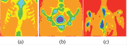 Visualizando Gammagramas Óseos en Colores