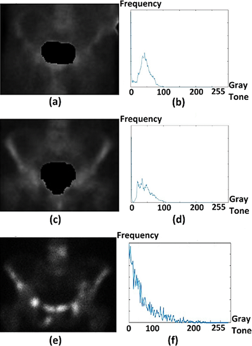 Determination of early bone metastasis on Bone Scans Using the Gray ...