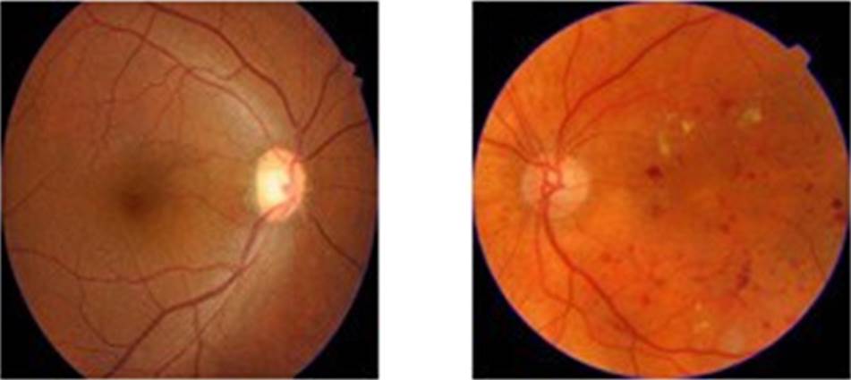 Detection of Exudates and Microaneurysms in the Retina by Segmentation ...